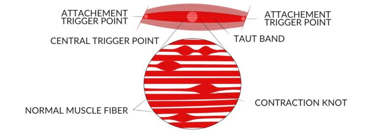 Muscle Knots: What Are They and How to Treat Them | HiDow
